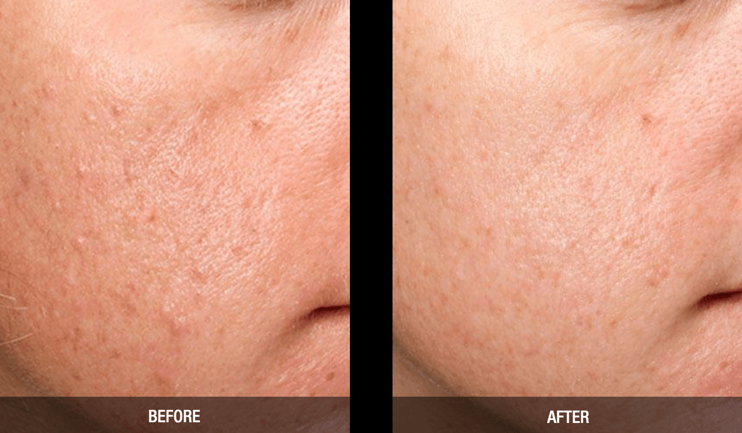 Exceed ™ Microneedling - Colbert Institute of Anti Aging