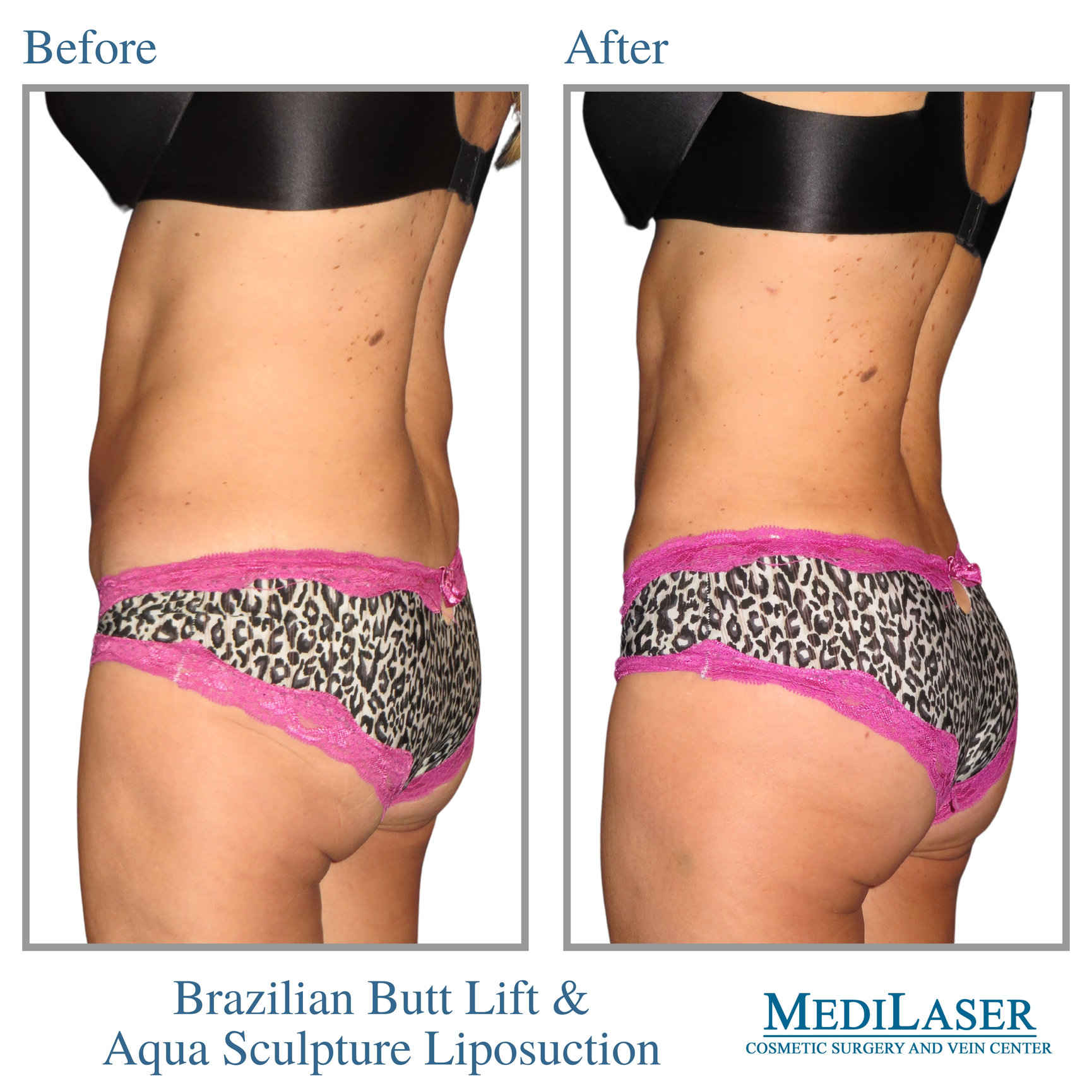 BBL Before & After | Medilaser | Frisco, TX