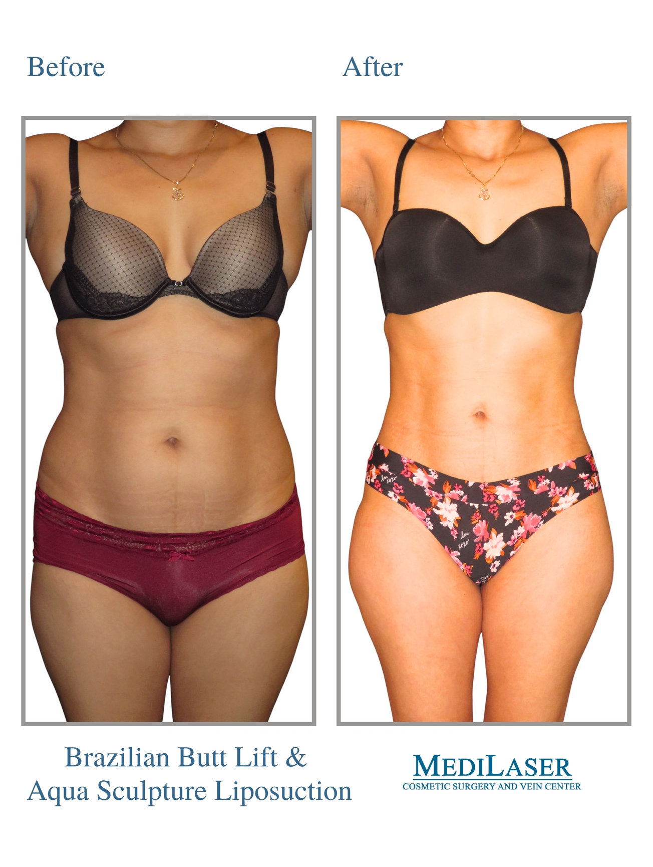 BBL Before & After | Medilaser | Frisco, TX